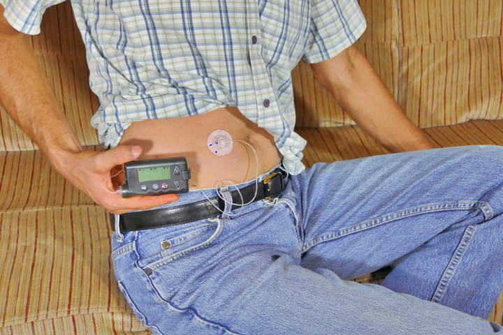 Tubeless Insulin Pumps: A life changing device for Diabetic Patients